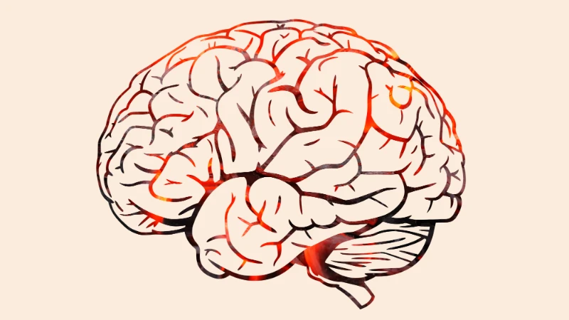 Smoldering MS – ist die „echte MS“ eine schwelende Erkrankung? | MS ...